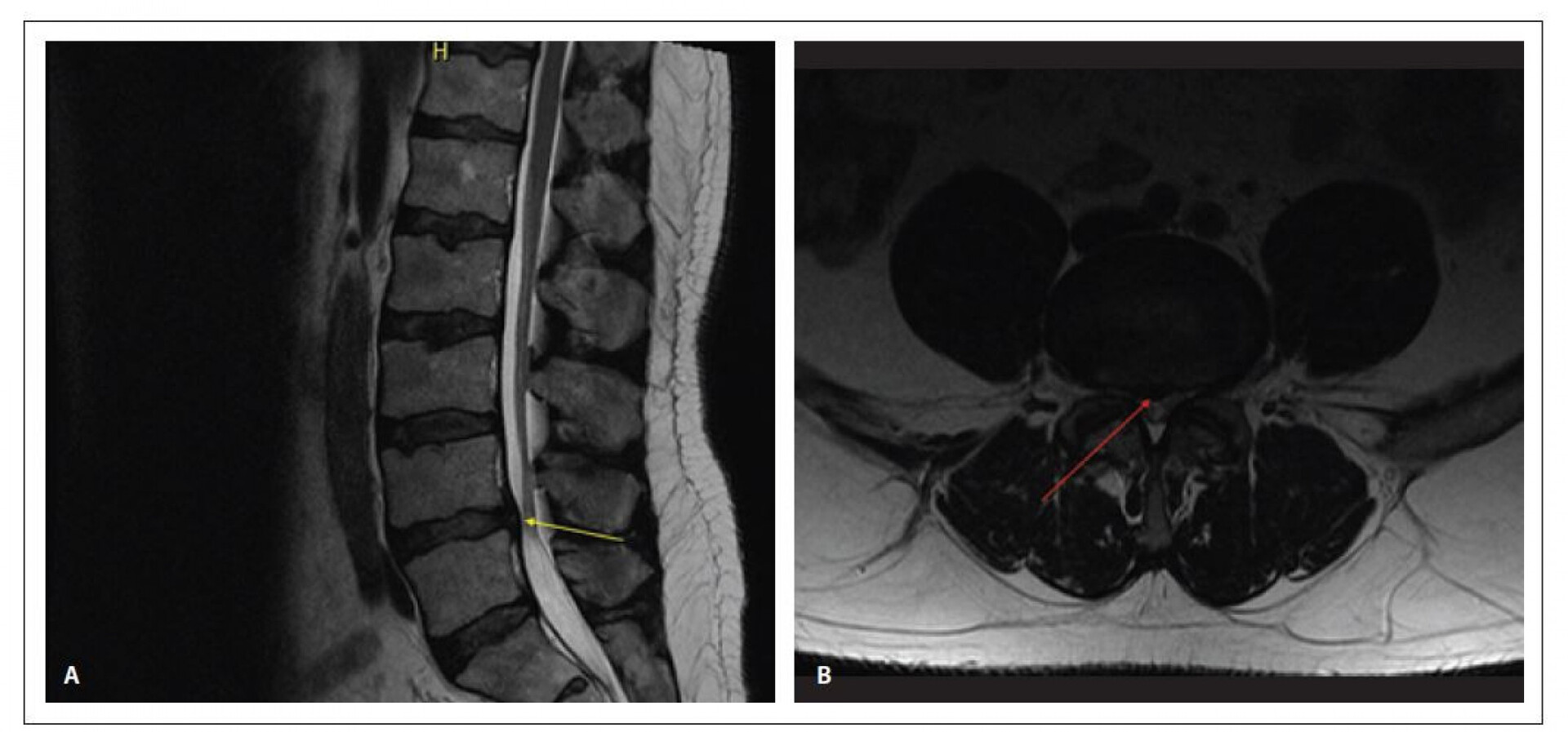 Successful nonsurgical management of lumbar radicul... | preLekára.sk